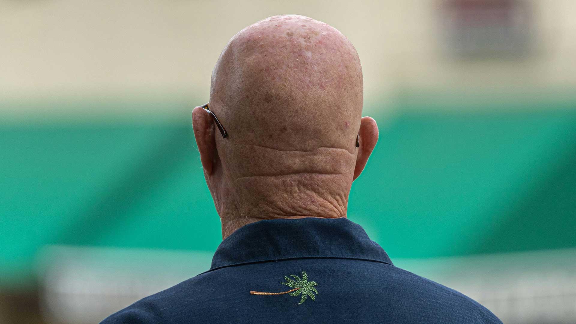 Waarom worden mannen kaal en wat kun je ertegen doen? - JFK